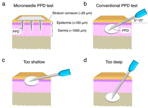 Replacing Standard Tuberculosis Skin Test Todays Medical Developments
