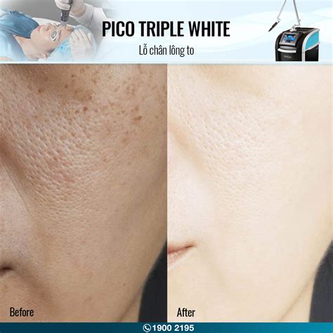 Pico Triple White Công Nghệ Điều Trị Da Toàn Diện Số 1
