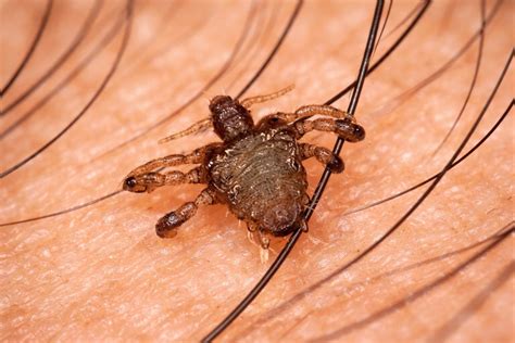 Crabs Pubic Lice Symptoms Causes Treatment And Prevention
