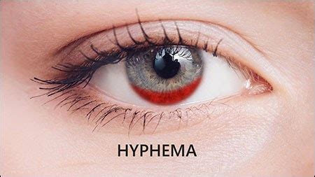 Hyphema How It Can Be Treated In Ayurveda Dr Vikrams Blog