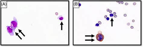Cns Lymphoma Involvement Detected By Csf Cytospin 79 Days After Car T Download Scientific