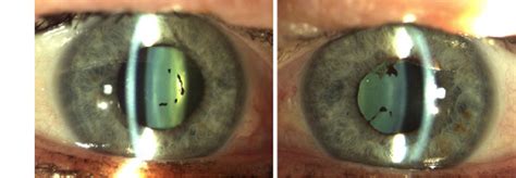 Right And Left Anterior Segment After The Anterior Uveitis Started In
