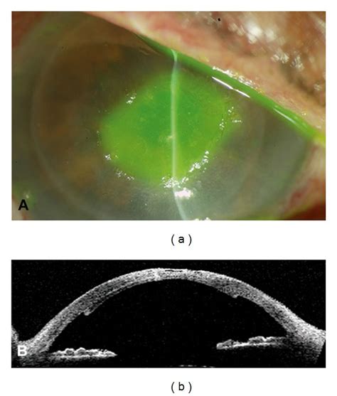 Day 1 Postoperatively A Slit Lamp Photography Showing Epithelial Download Scientific Diagram