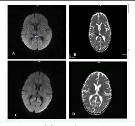 Pdf Transient Splenium Lesion Semantic Scholar