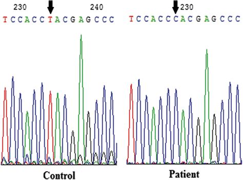Electropherograms Of Exon 13 Of Capn3 Gene Note The Transition Of