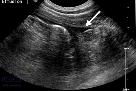 سونوگرافی گردن چیست؟ نحوه انجام سونوگرافی غدد لنفاوی گردن