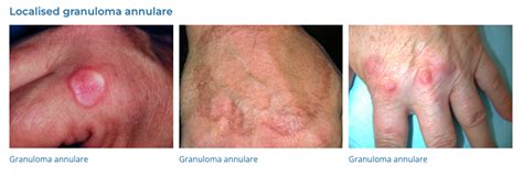 Dermatology 101 Conditions 81 100 Gp Exams