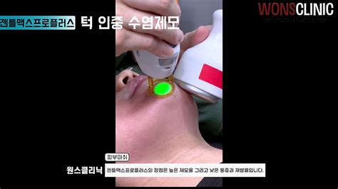 4k 젠틀맥스프로플러스 남자 턱 인중 수염제모 동영상 20250630 수원 원스의원