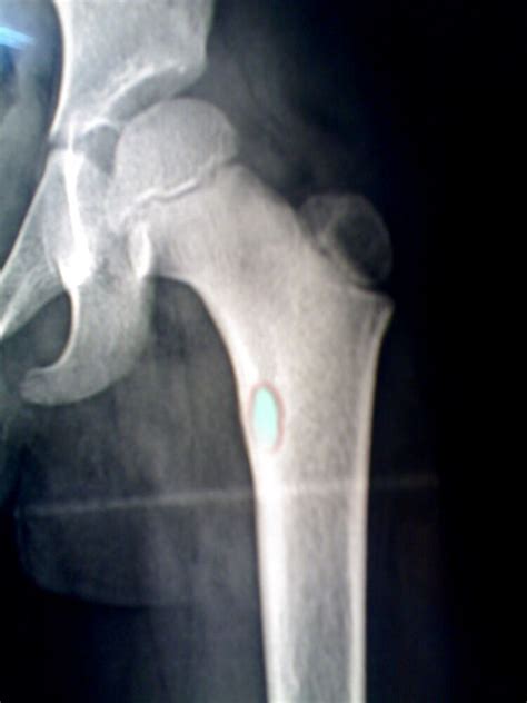 Osteomyelitis X Ray Features