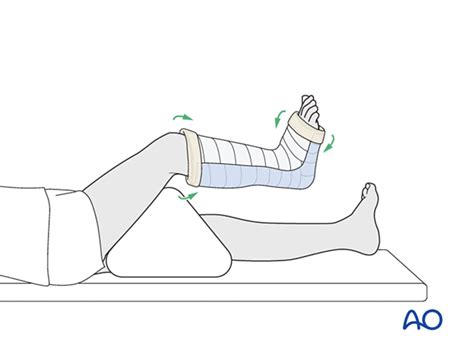 Nonoperative Treatment Splinting For Isolated Fibular Fracture