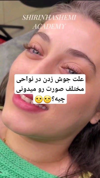 علت جوش زدن در نواحی مختلف صورت رو میدونی چیه؟😐😐 Youtube