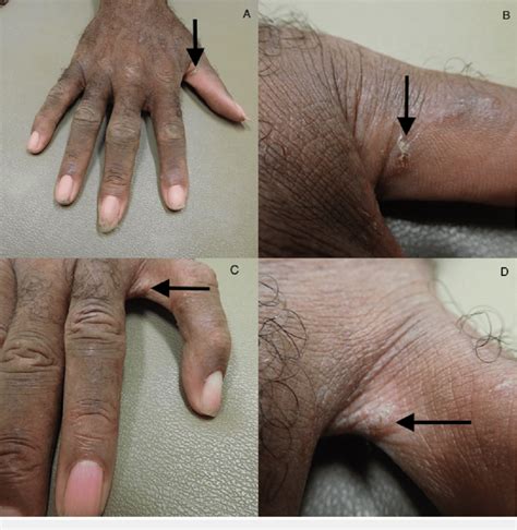 The Burrows Of The Sarcoptes Scabiei Mite Infestation Download