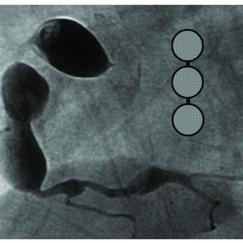 Transthoracic Echocardiology On The 16th Months After Illness Of