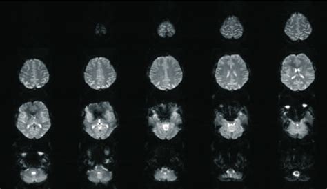 Example Of A Whole Brain Echo Planar Imaging Epi Dataset Collected In Download Scientific