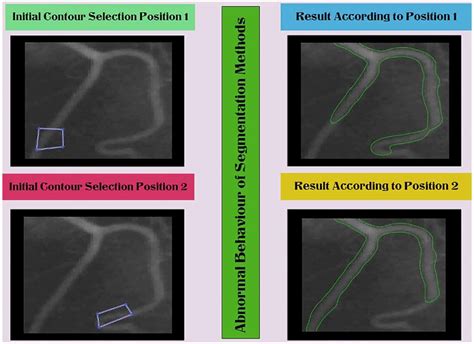 Segmentation Of Ct Image Using An Energy Based Method Download