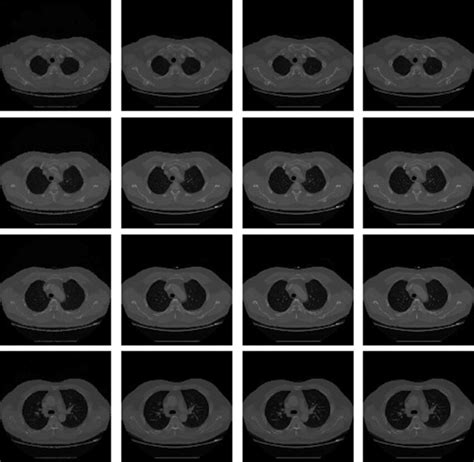 denoising effect for sp noise with noise level 0 4 for ct images the