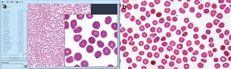 A Plasmodium Falciparum Infected Red Blood Cells In The Rbc View Of