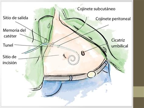 Técnica De Colocación De Cateter Tenckhoff Pptx