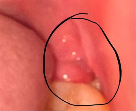 어금니 안쪽 잇몸이 너무 아픈데 뭐 때문일까요 지식in