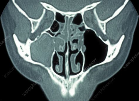 Infected Maxillary Sinus Ct Scan Stock Image M2600404 Science Photo Library
