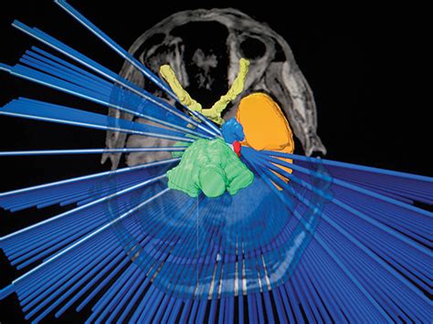 Linac Based Stereotactic Radiosurgery For Trigeminal Neuralgia