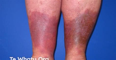 Acute Lipodermatosclerosis Image