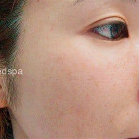 Sun Spot Removal Spa In Texas Glow Medspa