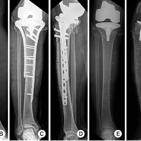 Periprosthetic Fracture Of The Proximal Tibia Was Fixed With Dual