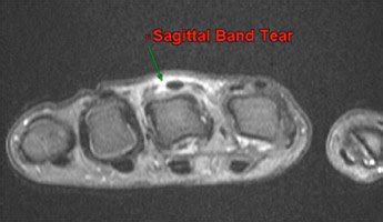 Sagittal Band Tear Boxers Knuckle” Hand And Wrist Institute