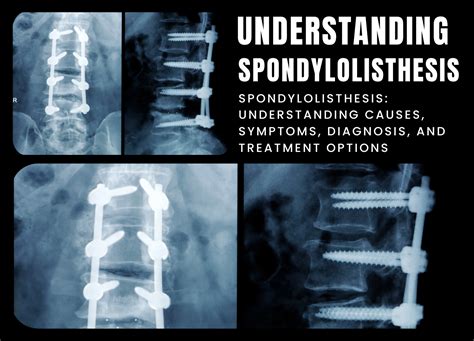 Spondylolisthesis Causes Symptoms Diagnosis And Treatment