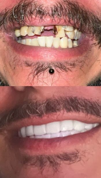 Dental Implant 2 Bionic Smile