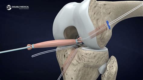 Anterior Cruciate Ligament Acl Reconstruction Surgery With Our Knee