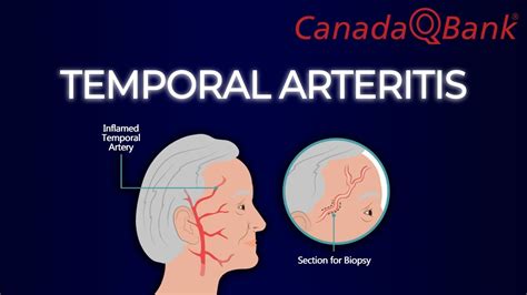 Temporal Arteritis Youtube