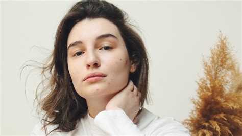 How To Hide A Pimple Without Makeup Lifestyle Hacks MBGON Most Beautiful Girl Online