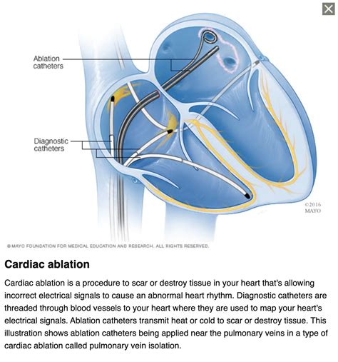Does Obstructive Sleep Apnea Osa Cause Atrial Fibrillation Afib