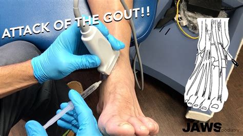 Gout Ankle