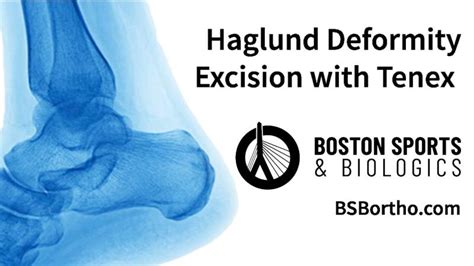Haglund Deformity Surgery With Tenex Giuseppe Quarta