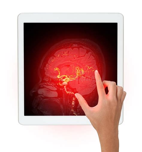 A Hand Touches A Tablet Screen Displaying A Brightly Highlighted Mri Brain Scan Focusing On The