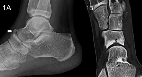 Navicular Stress Syndrome Giau