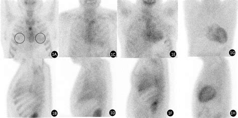 Application Of 99tcm Pyp In Transthyretin Cardiac Amyloidosis Journal Of Nuclear Medicine