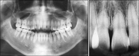 Glossectomy As An Adjunct To Correct An Open Bite Malocclusion With Shortened Maxillary Central