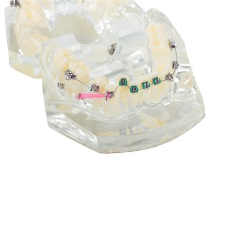 Model Aparat Dentar Cu Bracketi Pentru Anatomia Maxilarului Si Dintilor