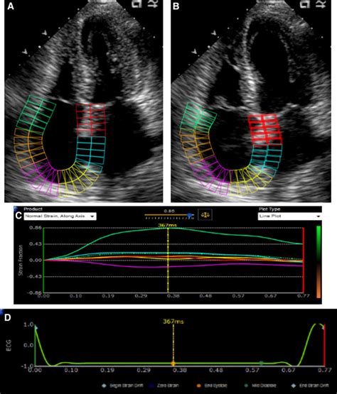 Right Atrial Strain Assessment With 2d Speckle Tracking In The Apical