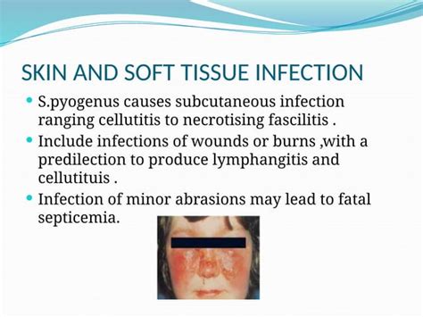 Streptococcus Pyogenes Introduction Classification Ppt