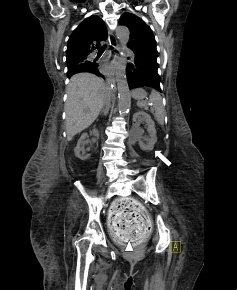 A Unique Case Of Bilateral Hydronephrosis Caused By A Fecalith Pmc