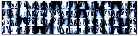 chest x ray images classification using transfer learning with pytorch