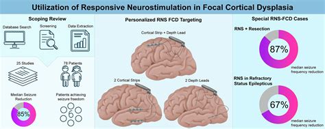 A Scoping Review Of Responsive Neurostimulation In Focal Cortical