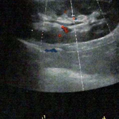 Intrarenal Venous And Arterial Doppler With Interrupted Diastolic Download Scientific Diagram