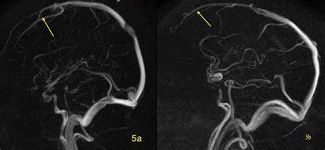 Arachnoid Granulations Commonest Locations And Appearences Download
