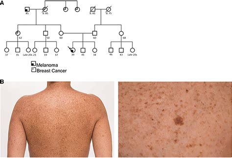 A Novel Missense Variant And Multiexon Deletion Causing A Delayed Presentation Of Xeroderma